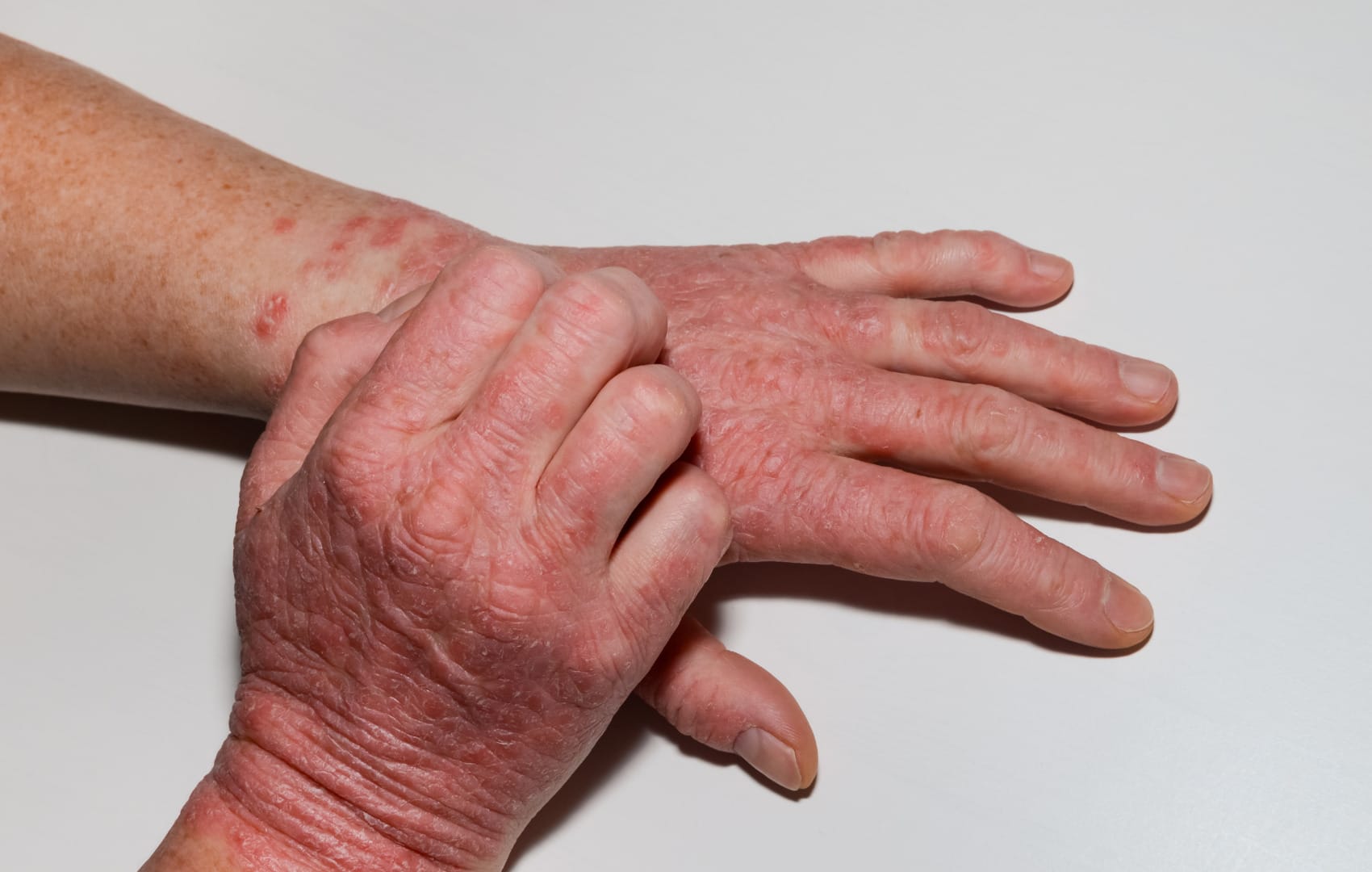 Natural Ways to Deal With Eczema On Hands - Dr. Ana-Maria Temple