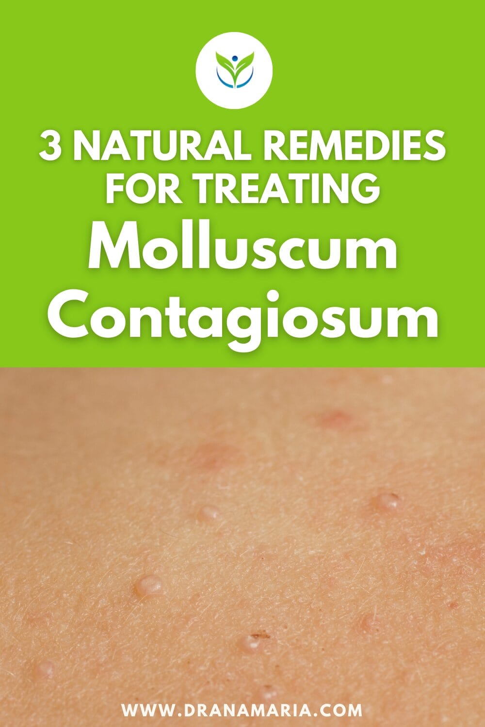 3 Natural Remedies for Treating Molluscum Contagiosum - Dr. Ana-Maria ...